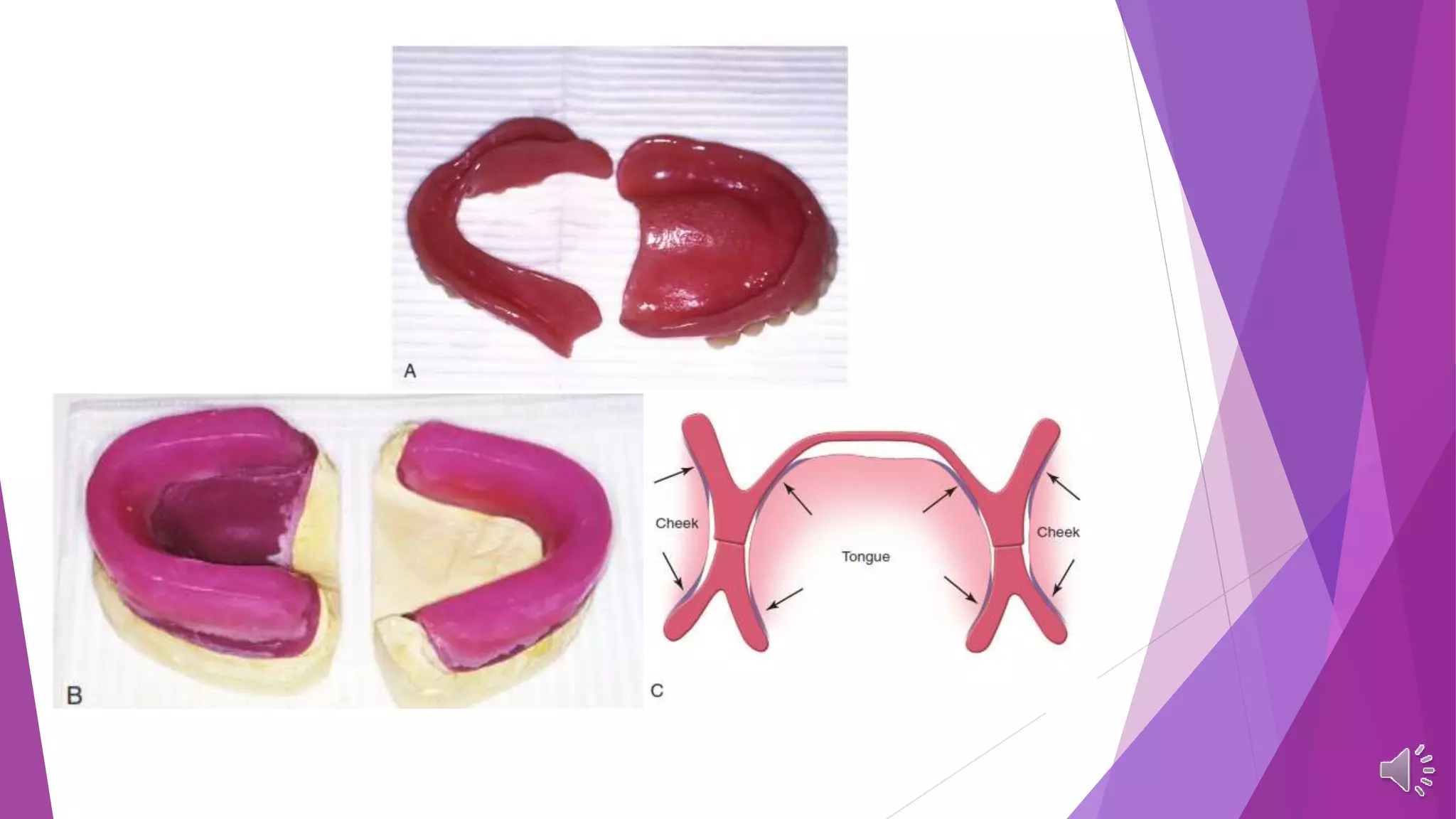 Components of a complete denture | PPTX