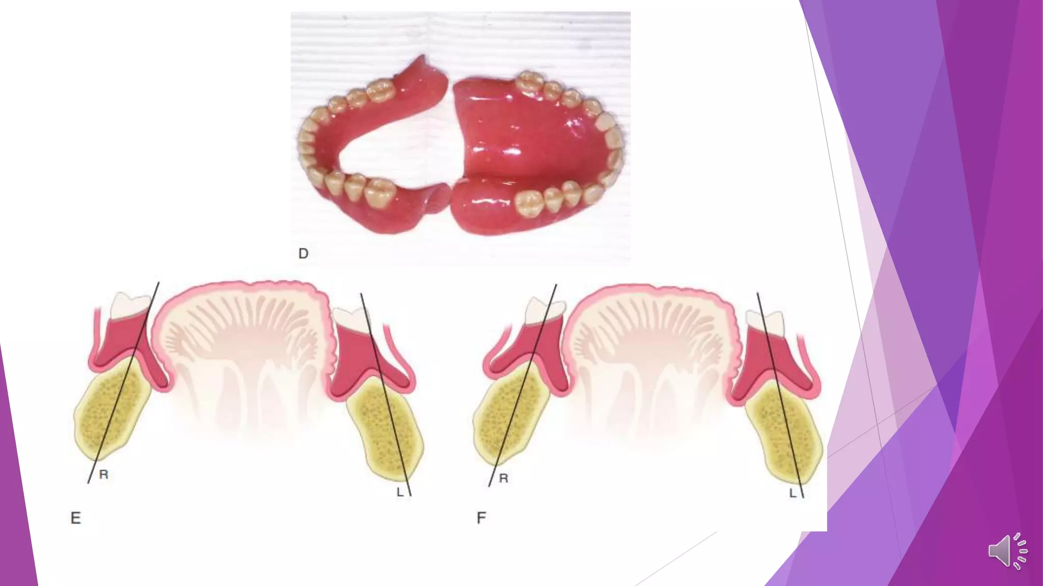 Components of a complete denture | PPTX