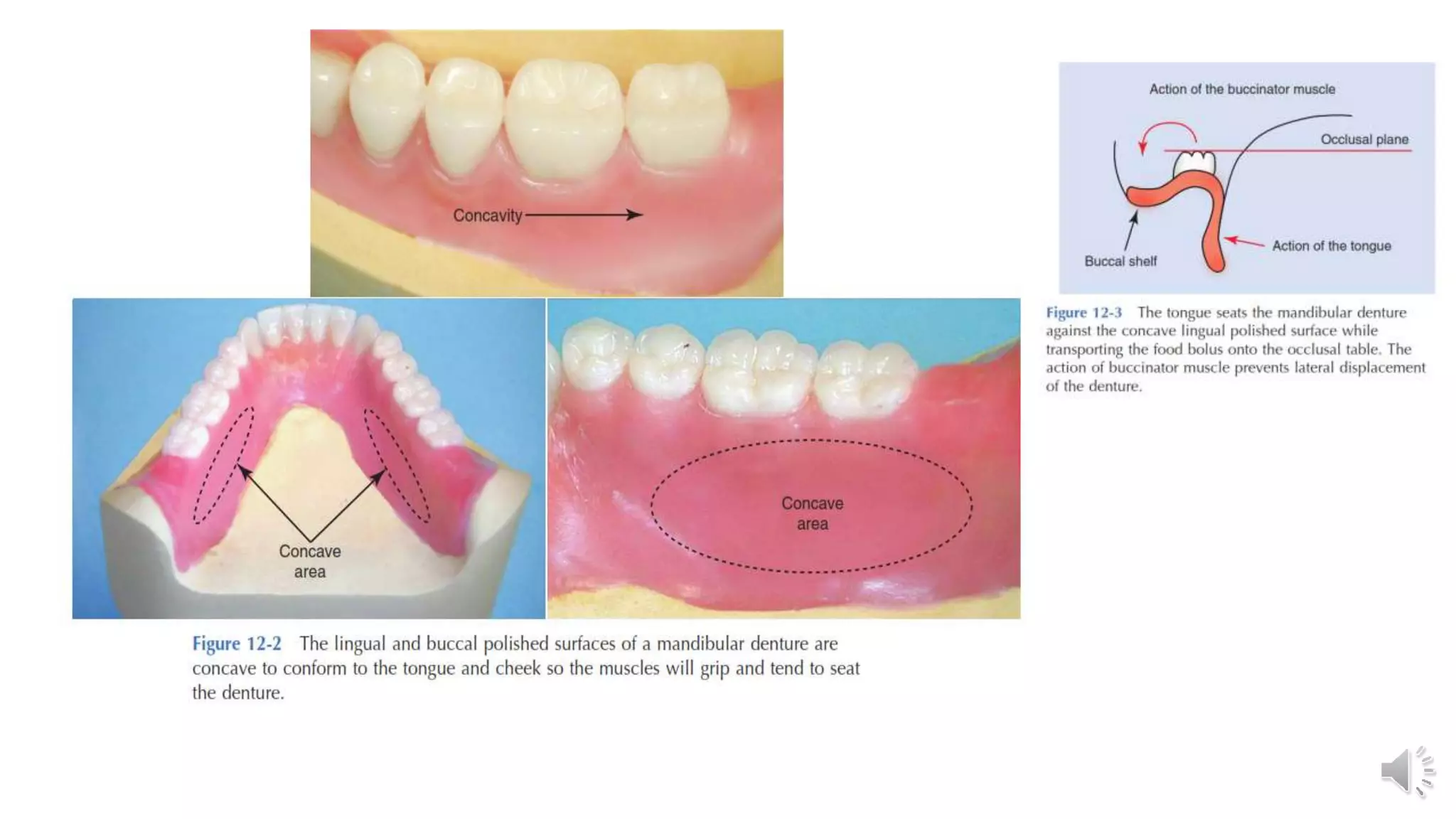 Components of a complete denture | PPTX