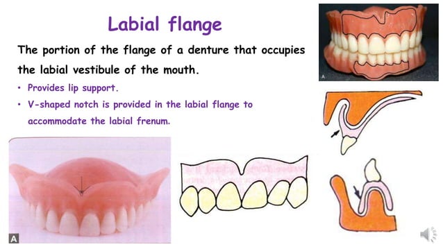 Components of a complete denture | PPTX