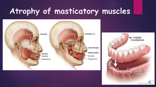 Sequelae of wearing complete dentures | PPTX
