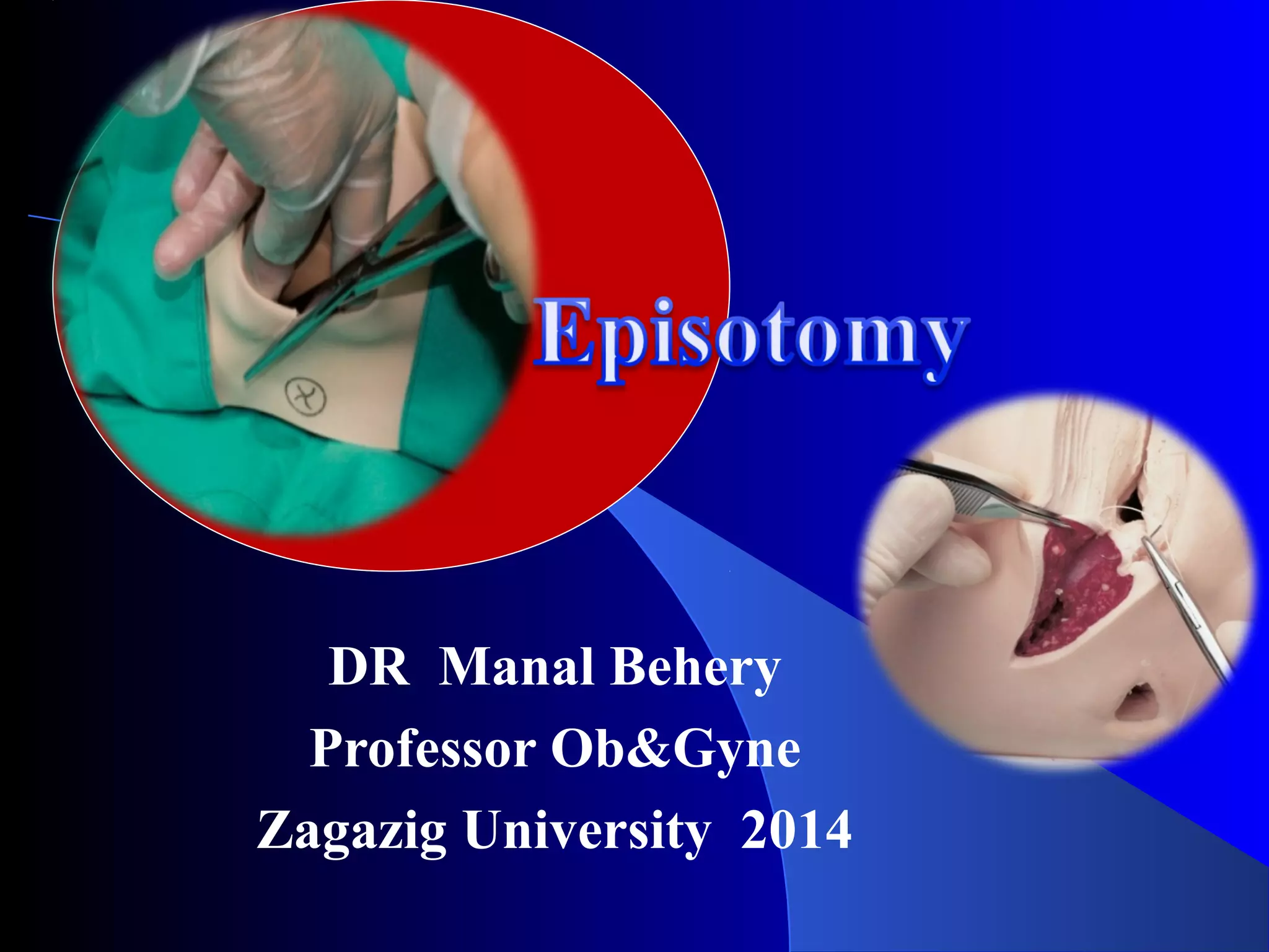 Episotomy for undergraduate | PPT