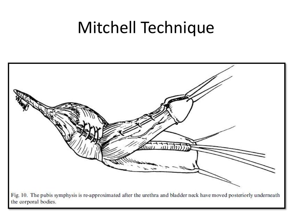 Management of Epispadia