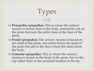 Epispadias | PPTX