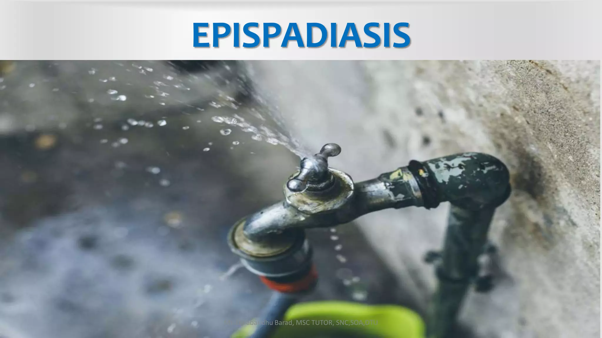 EPISPADIAS (CONGENITAL ANOMALY OF GENITOURINARY SYSTEM) | PPTX