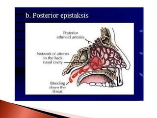 Epistaksis | PPTX