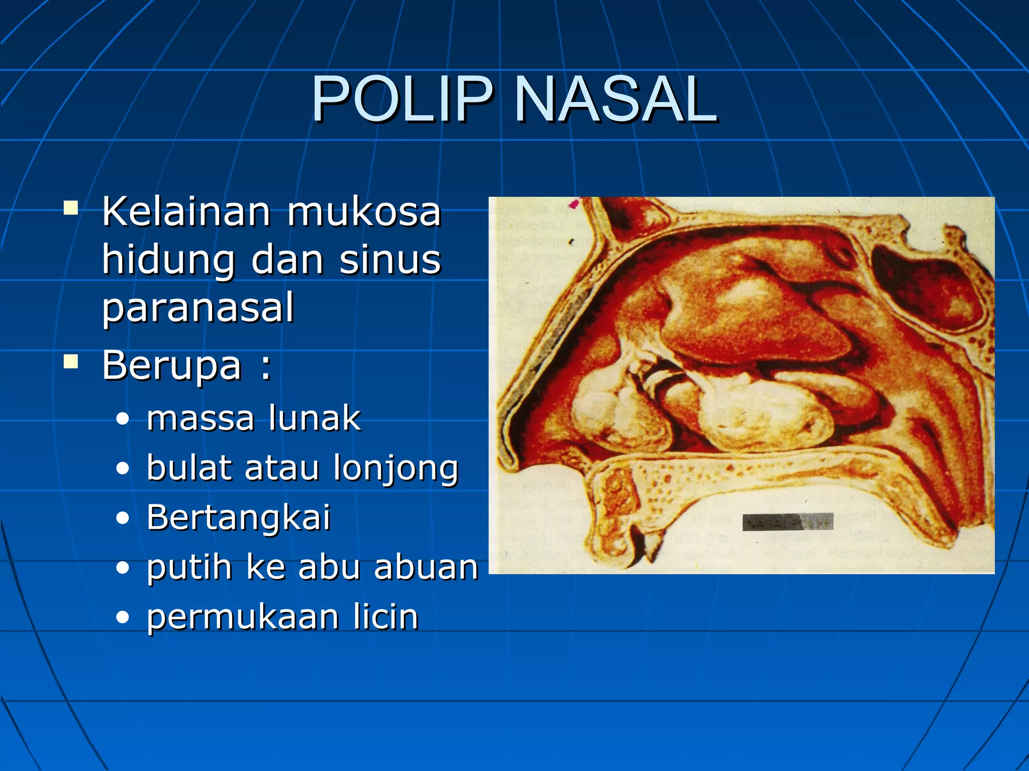 Epistaksis | PPT