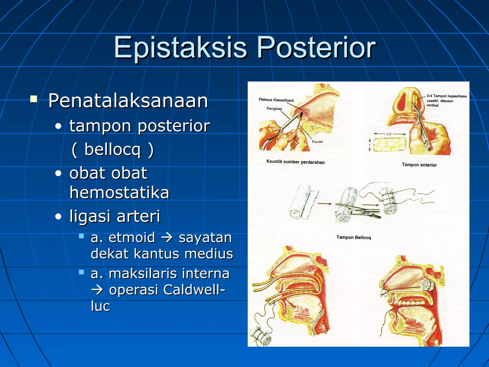 Epistaksis | PPT
