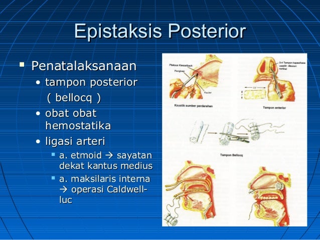 Epistaksis
