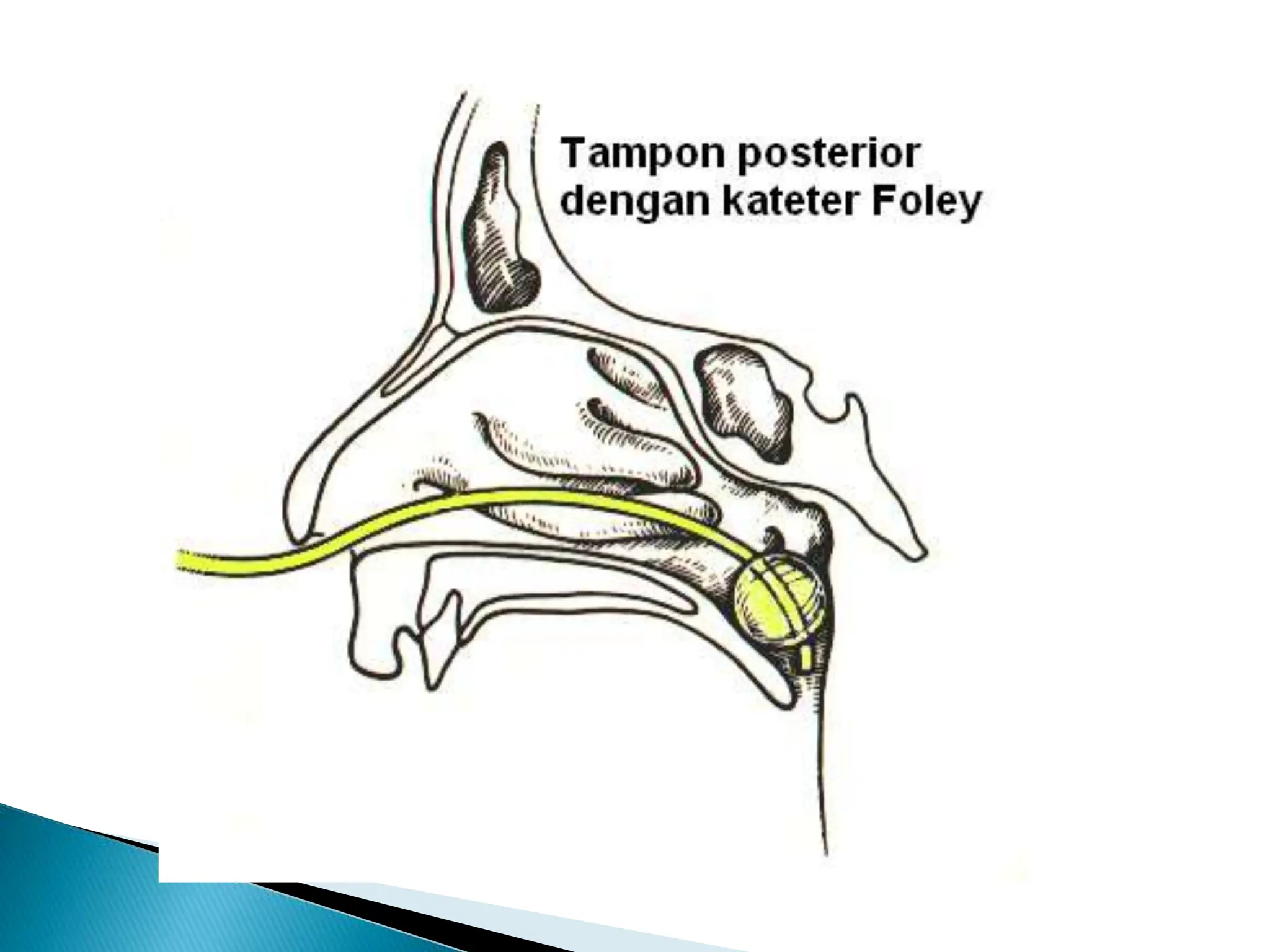 penegakan diagnosis dan tatalaksana epistaksis | PPTX