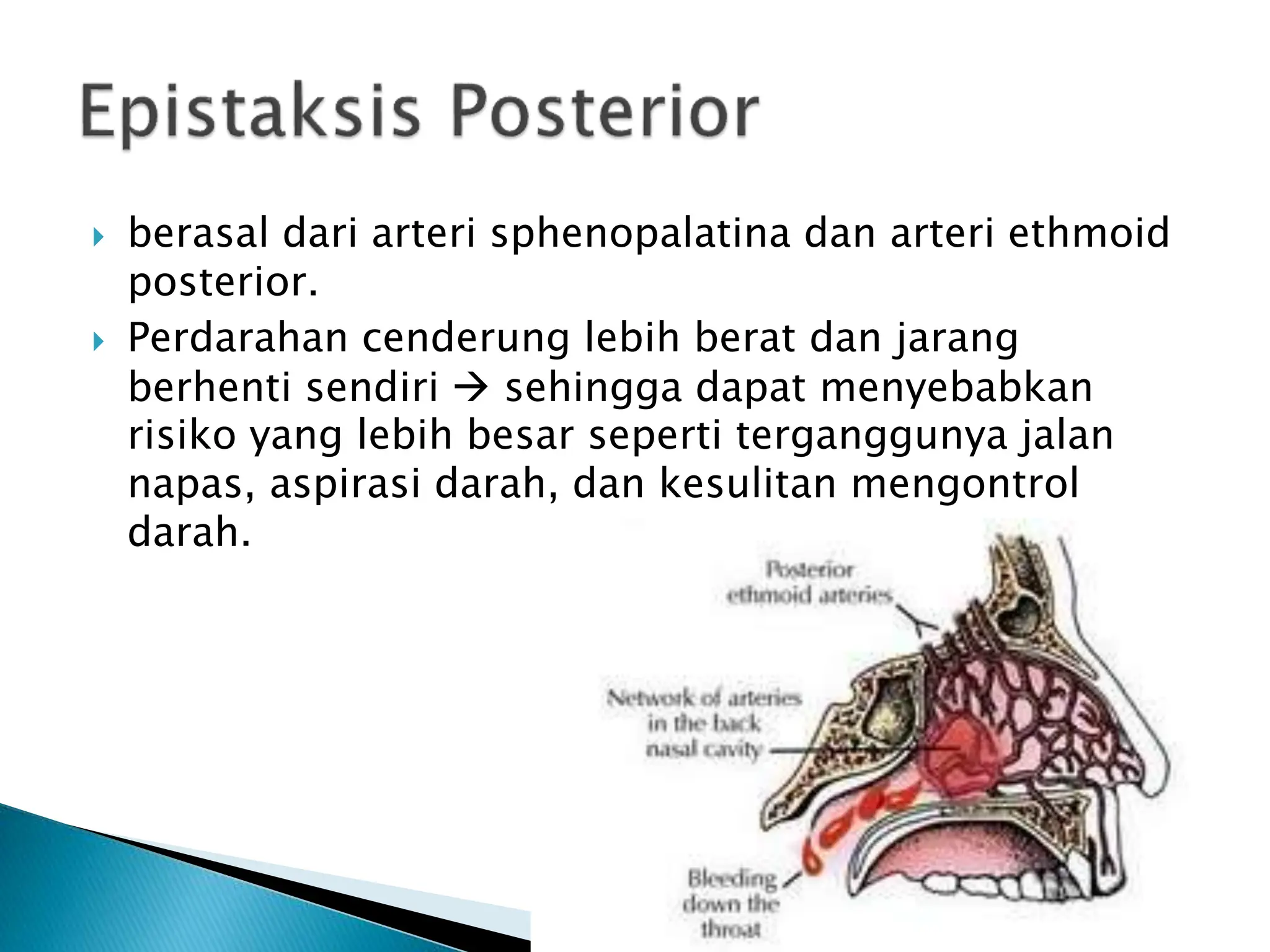 penegakan diagnosis dan tatalaksana epistaksis | PPTX
