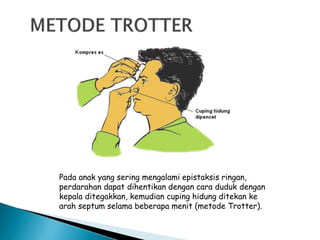 penegakan diagnosis dan tatalaksana epistaksis | PPTX