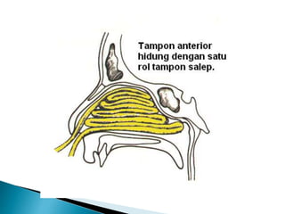 penegakan diagnosis dan tatalaksana epistaksis | PPTX