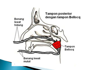 penegakan diagnosis dan tatalaksana epistaksis | PPTX