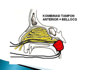 penegakan diagnosis dan tatalaksana epistaksis | PPTX