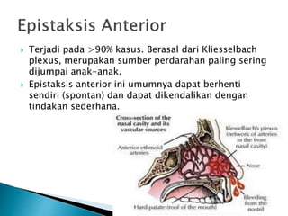 penegakan diagnosis dan tatalaksana epistaksis | PPTX