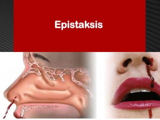 Epistaksis fixed, manajemen mimisan.pptx