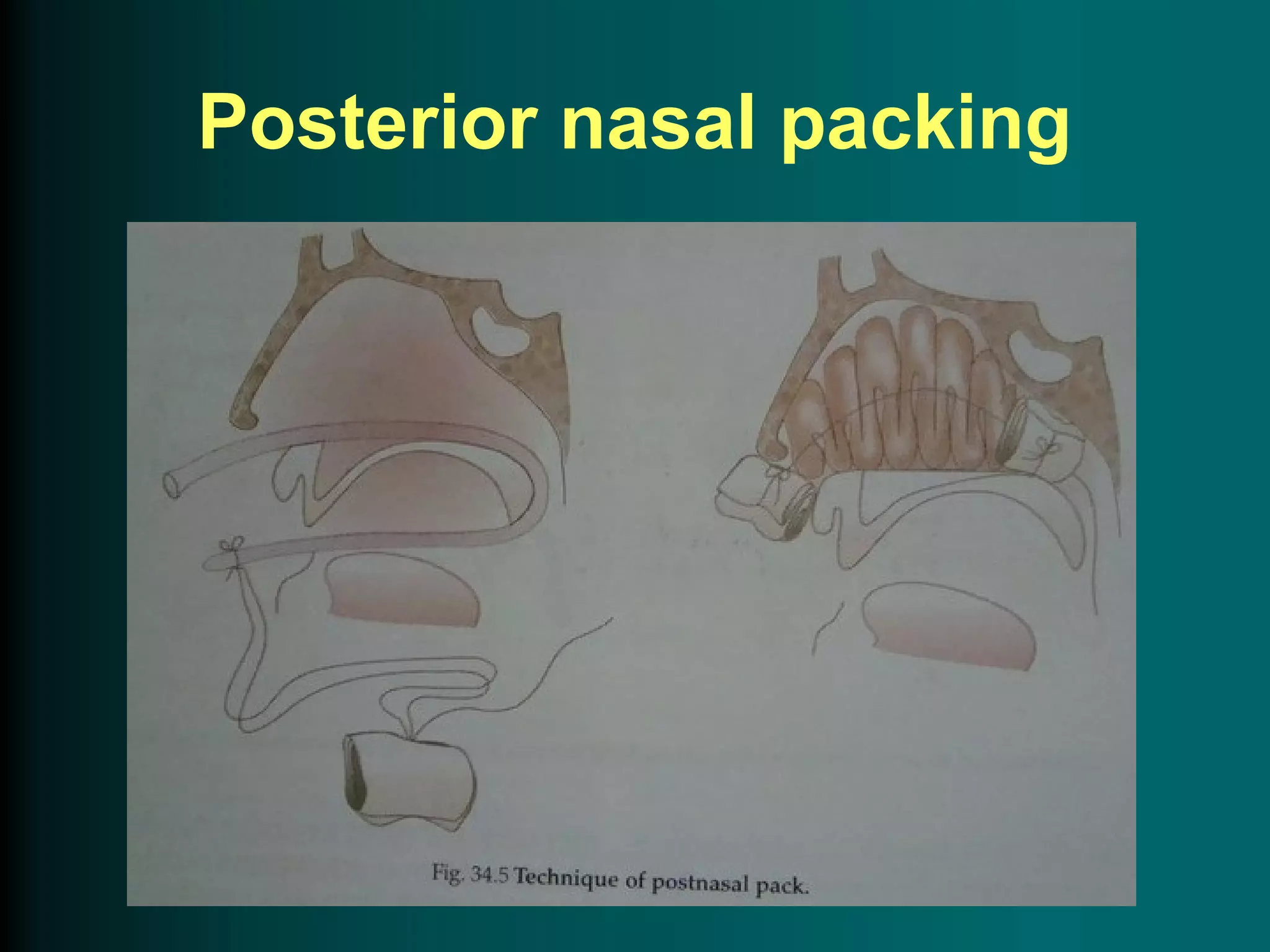 Epistaxis | PPT