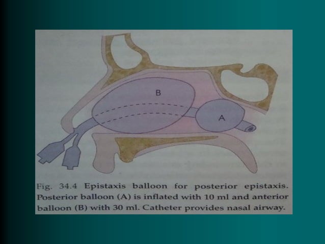 Epistaxis | PPT
