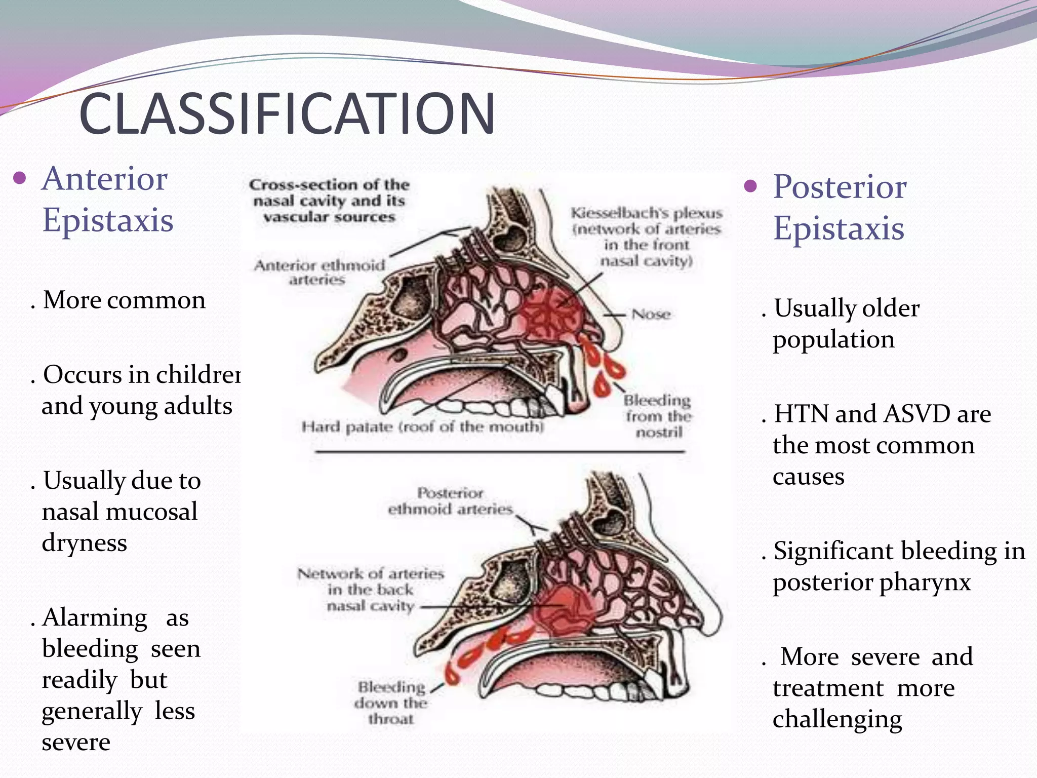 Epistaxis | PPTX