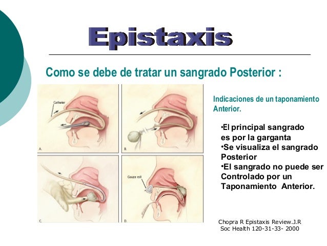 Epistaxis