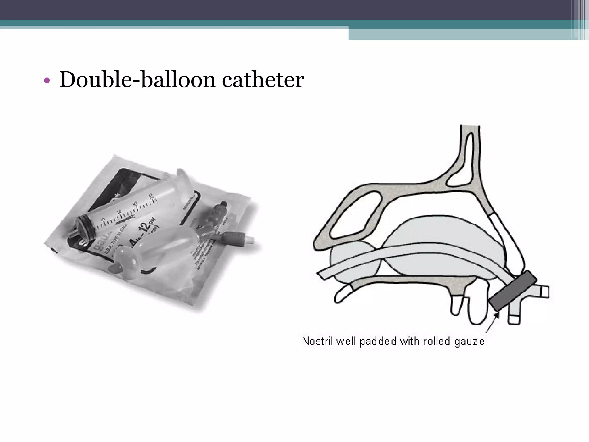 Epistaxis | PPT