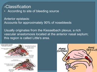 Epistaxis, | PPT