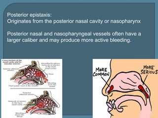 Epistaxis, | PPT