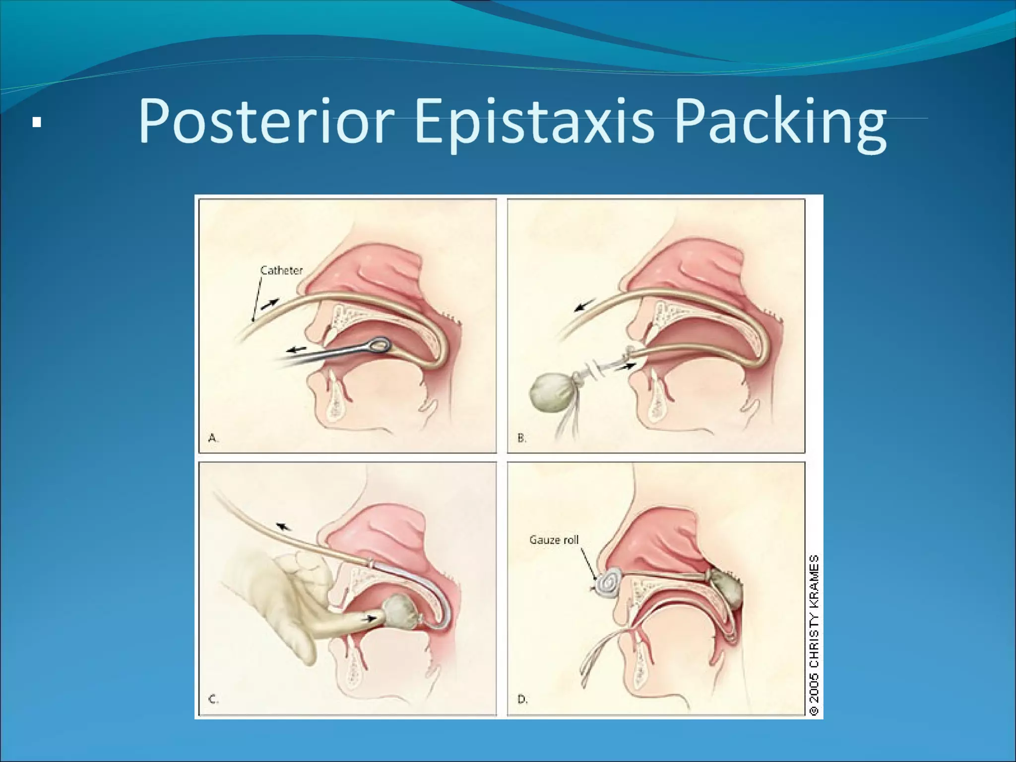 Epistaxis- Nose Bleed Overview and Managment | PPT