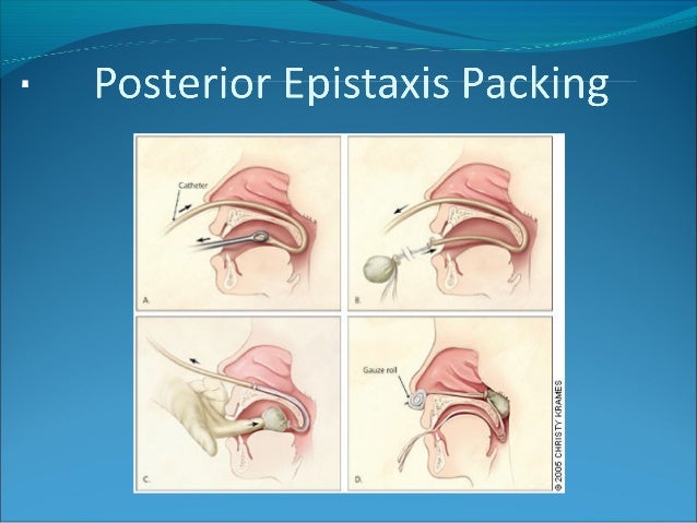Epistaxis- Nose Bleed Overview and Managment