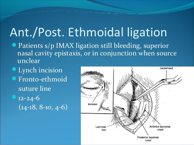 Epistaxis- Nose Bleed Overview and Managment