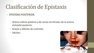 Epistaxis | PPTX