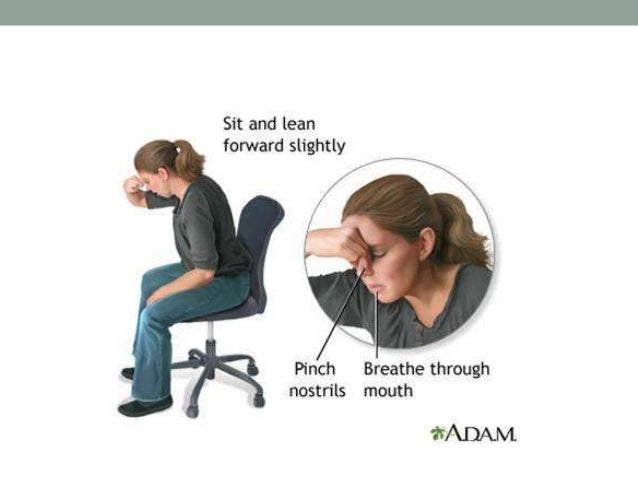 Epistaxis
