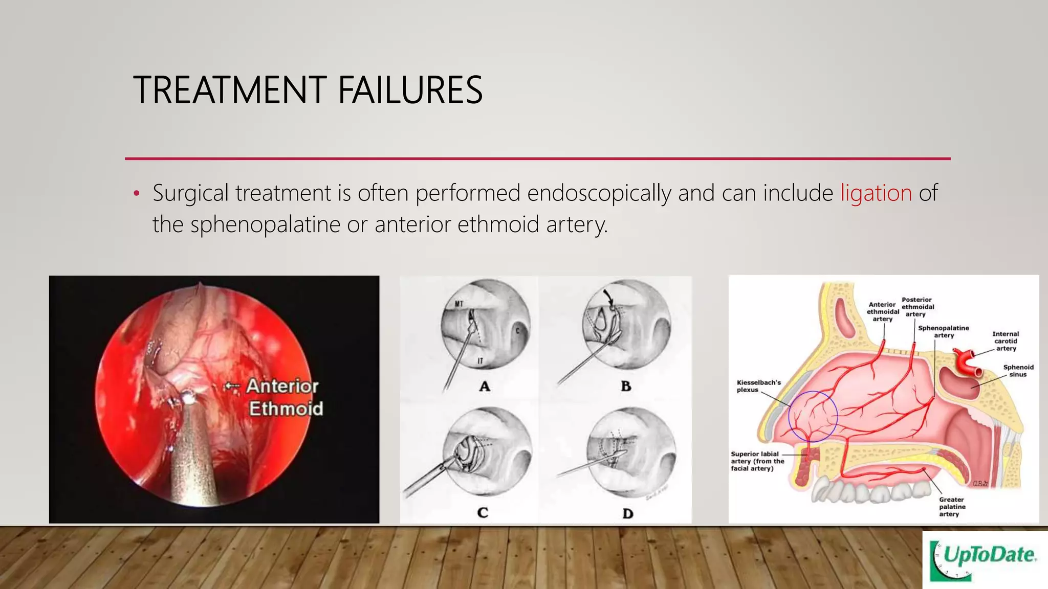 Epistaxis update management & Treatment from: AAFP, Uptodate 2017 | PPTX