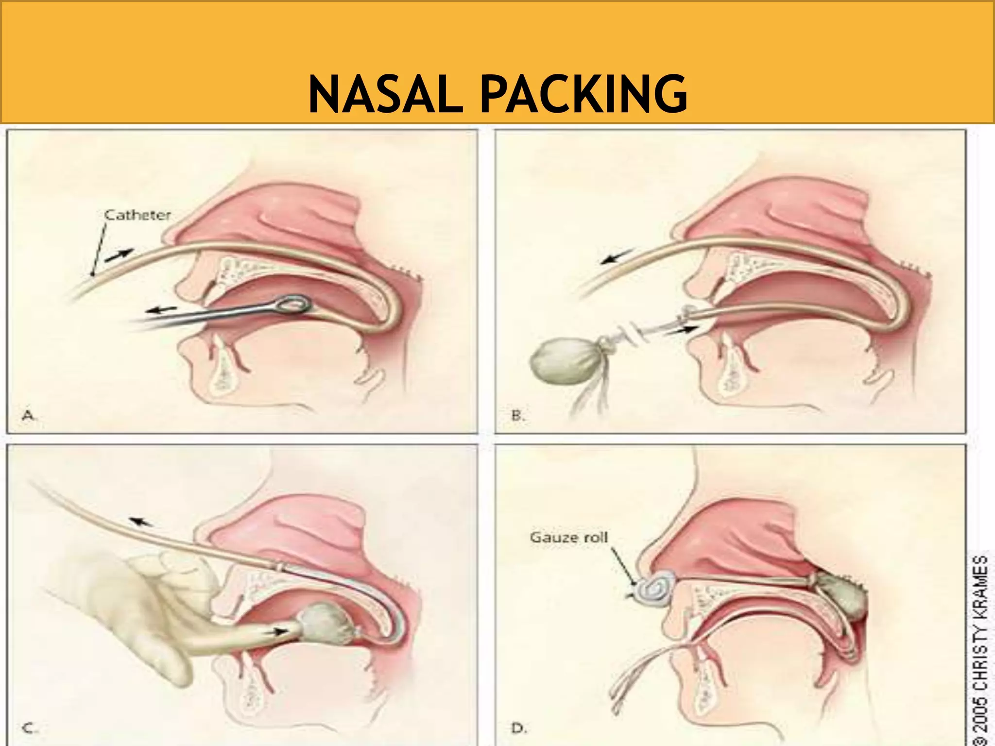 Epistaxis ( nose bleed) | PPTX