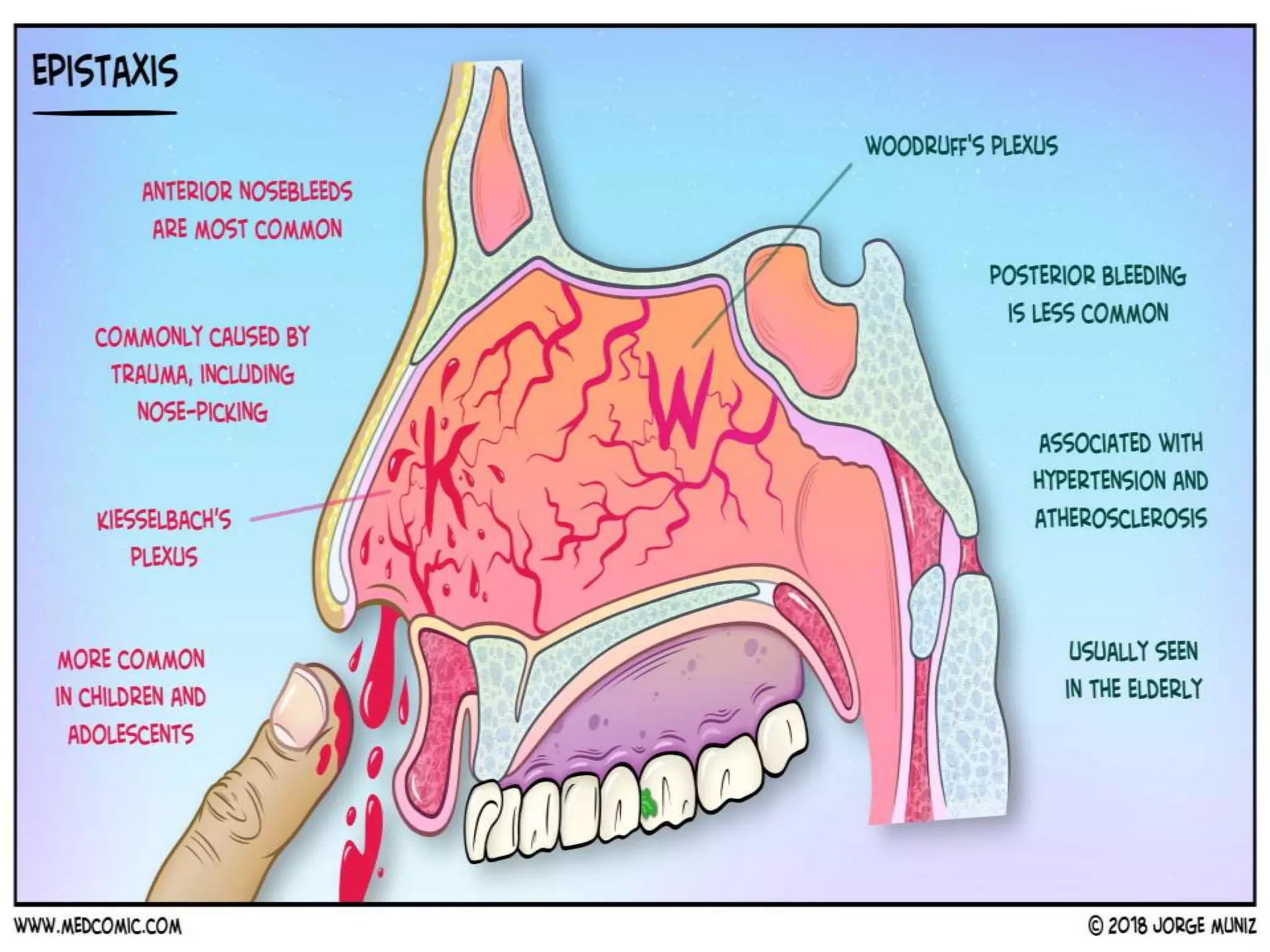 Epistaxis ( nose bleed) | PPTX