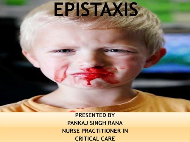 Epistaxis ( nose bleed) | PPTX | First Aid | Injuries