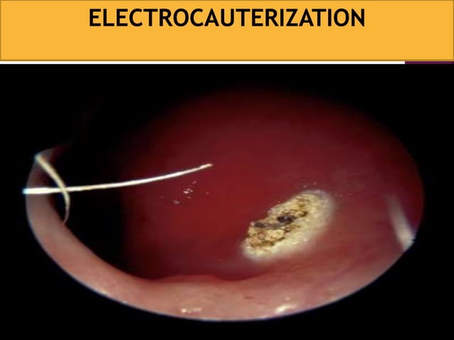 Epistaxis ( nose bleed) | PPTX | First Aid | Injuries