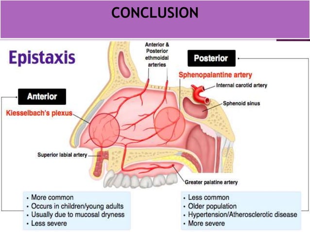 Epistaxis ( nose bleed) | PPTX | First Aid | Injuries