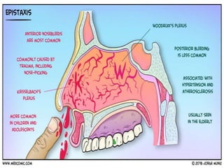 Epistaxis ( nose bleed) | PPTX