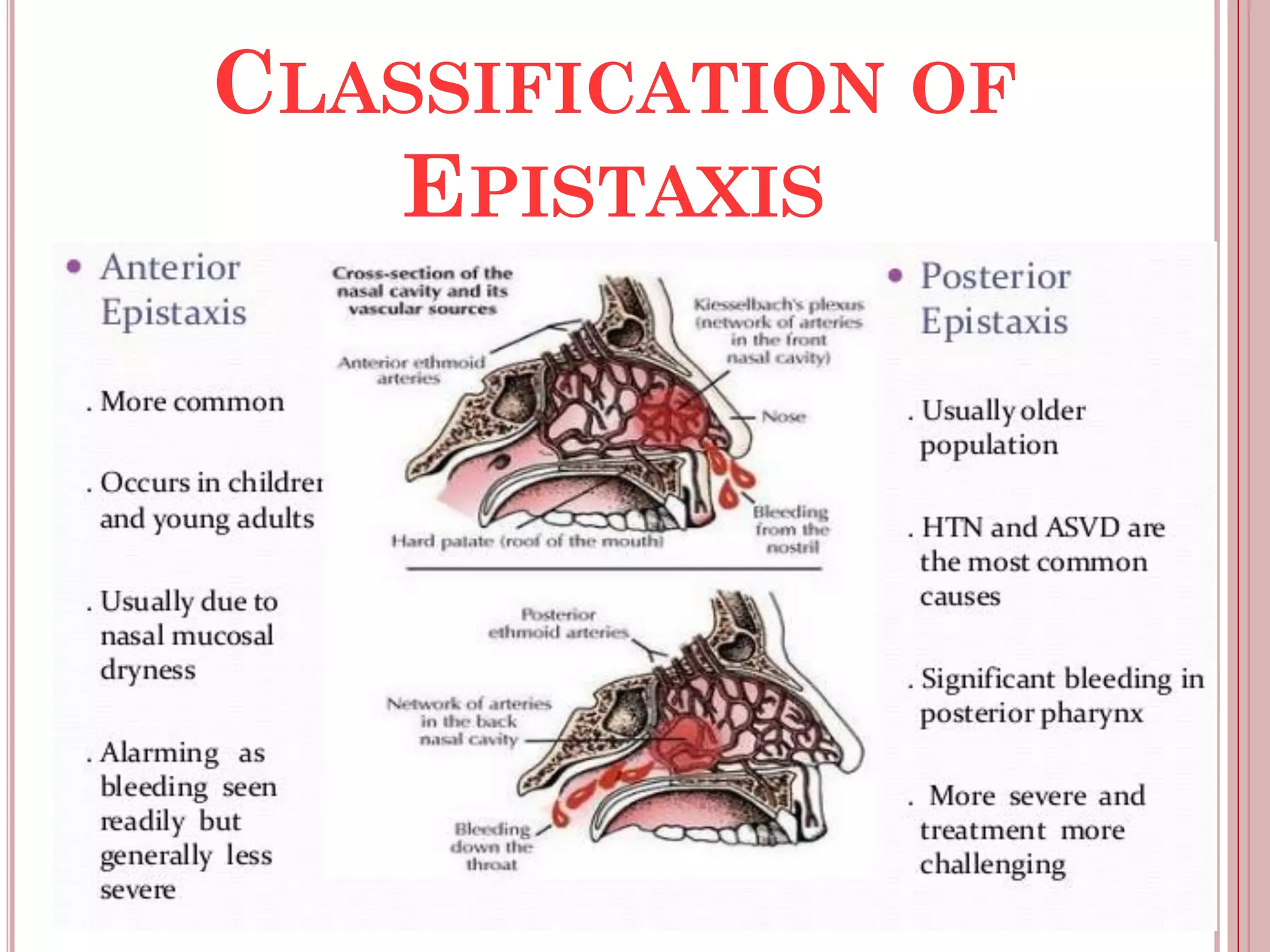 Epistaxis | PDF
