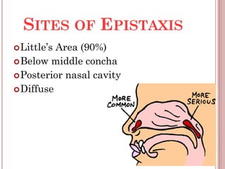 Epistaxis | PDF