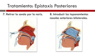 Epistaxis | PDF