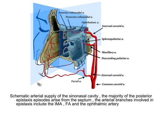 Embolization for Epistaxis | PPT | First Aid | Injuries