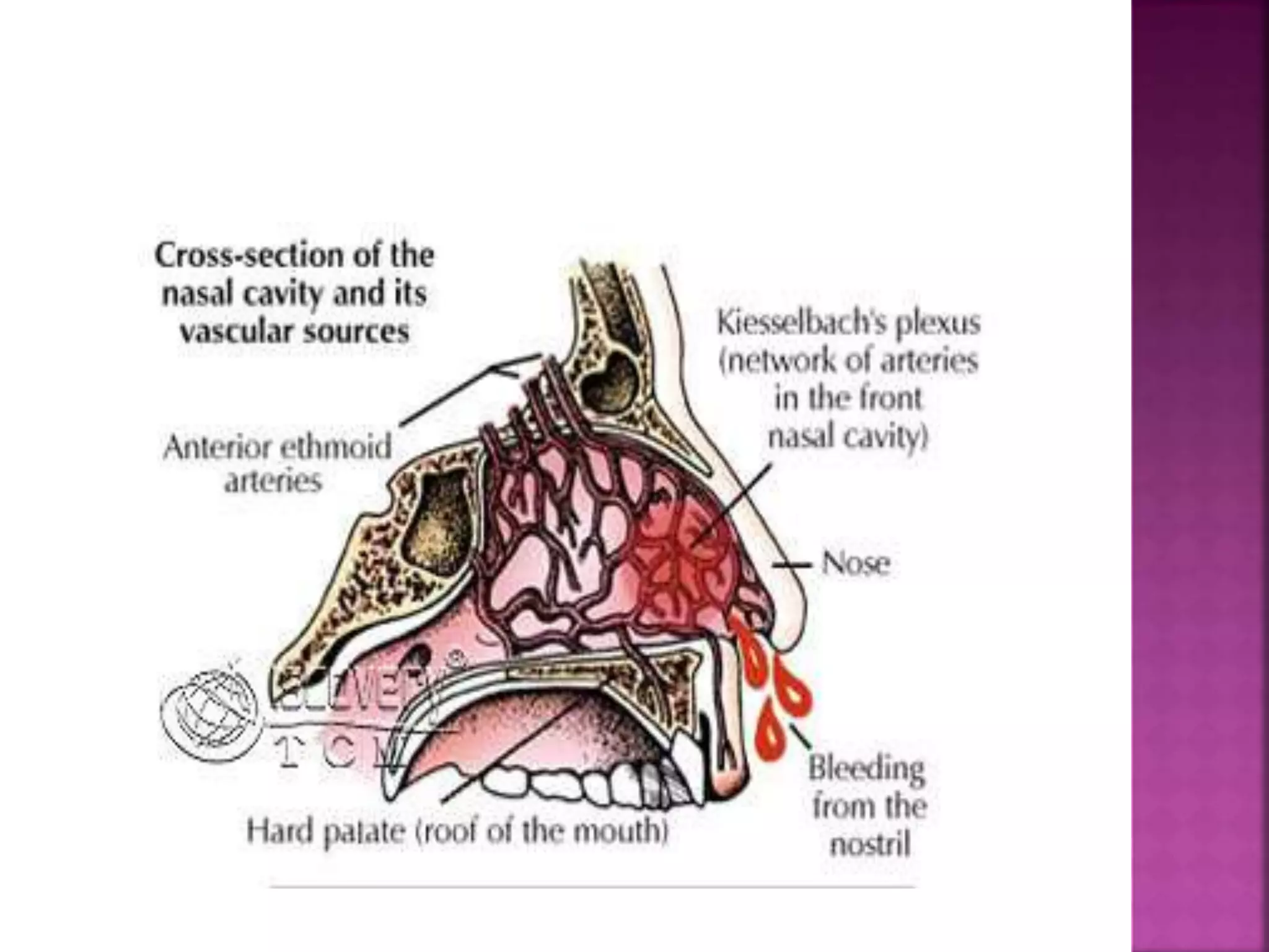 Epistaxis and its surgical and nursing management | PPTX