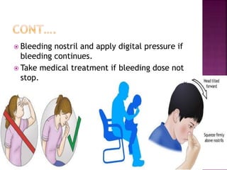 Epistaxis and its surgical and nursing management | PPTX