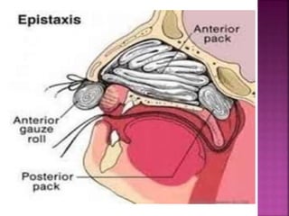 Epistaxis and its surgical and nursing management | PPTX