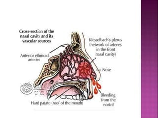 Epistaxis and its surgical and nursing management | PPTX
