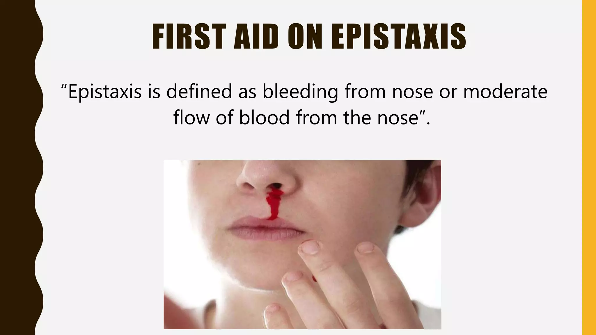First aid for Epistaxis | PPTX