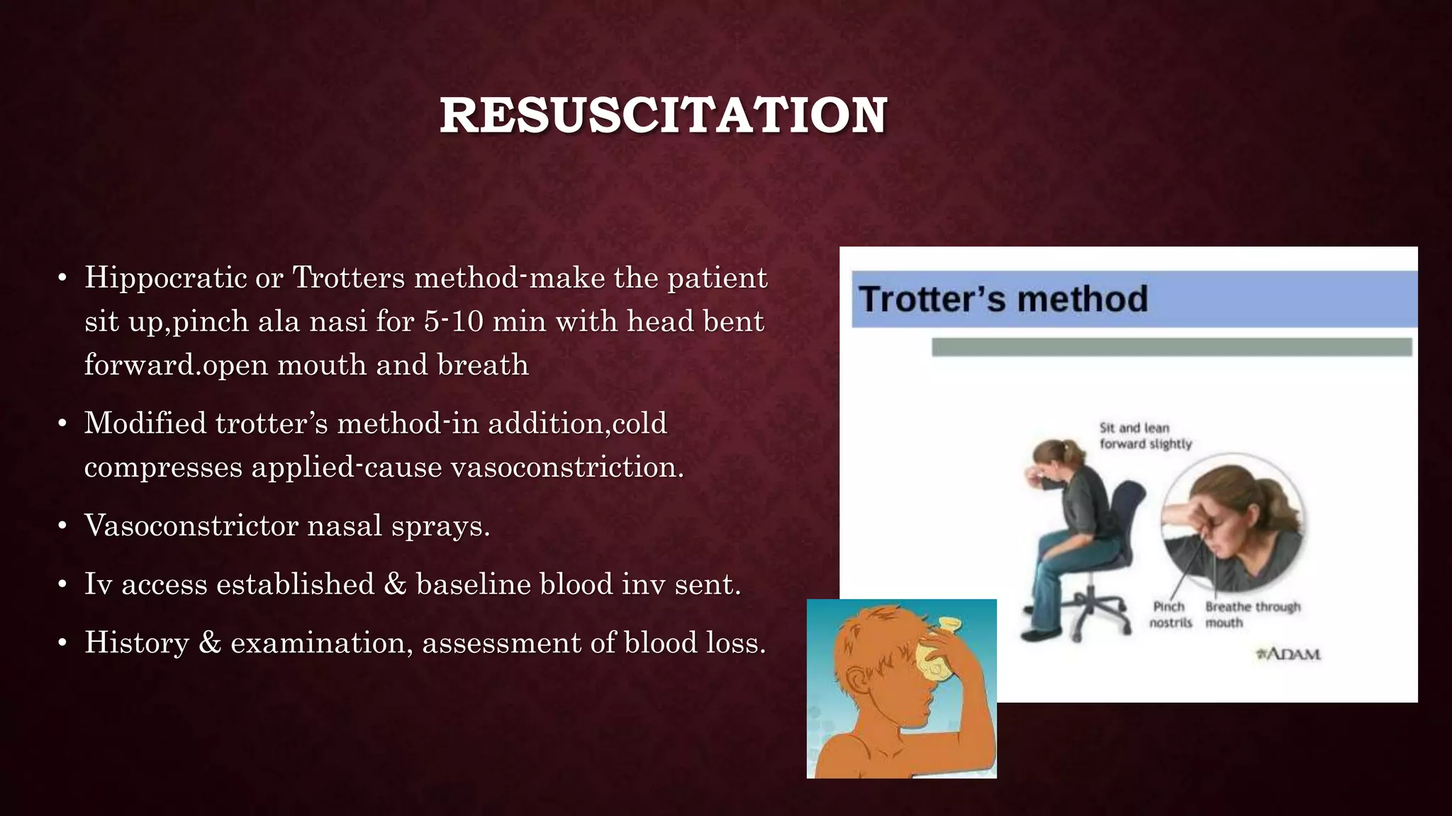 Epistaxis.pptx